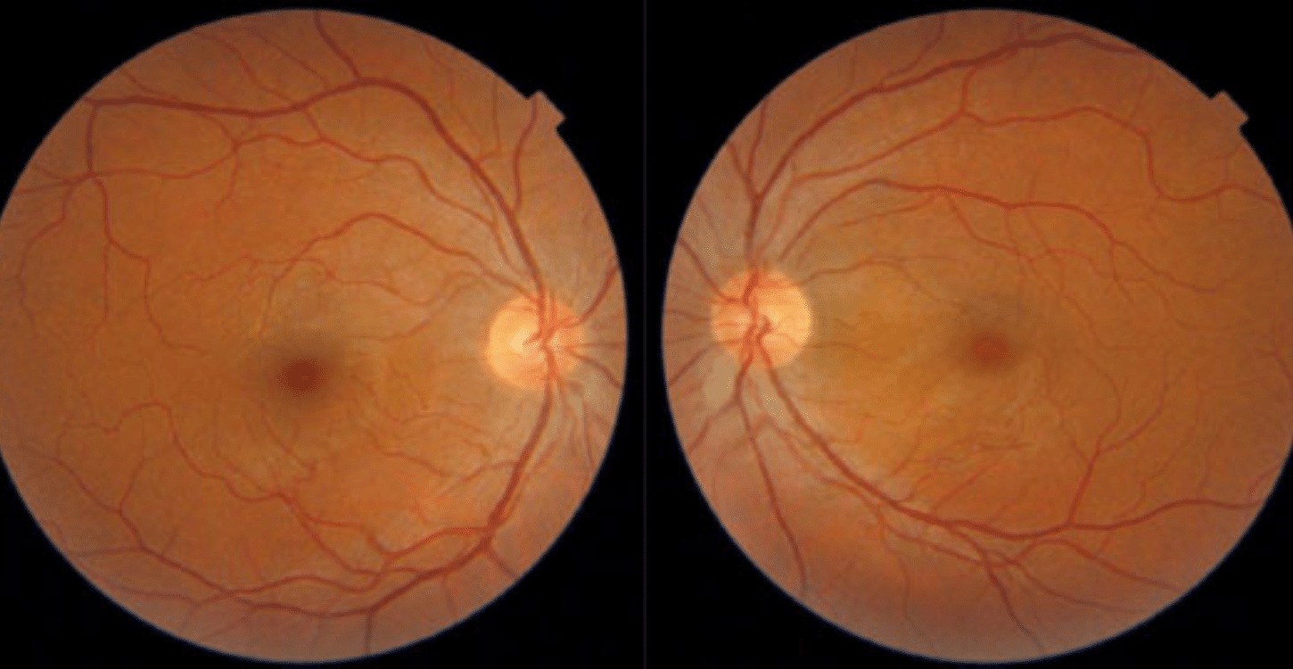 Exames de Retina: conheça os mais importantes e quando realizar