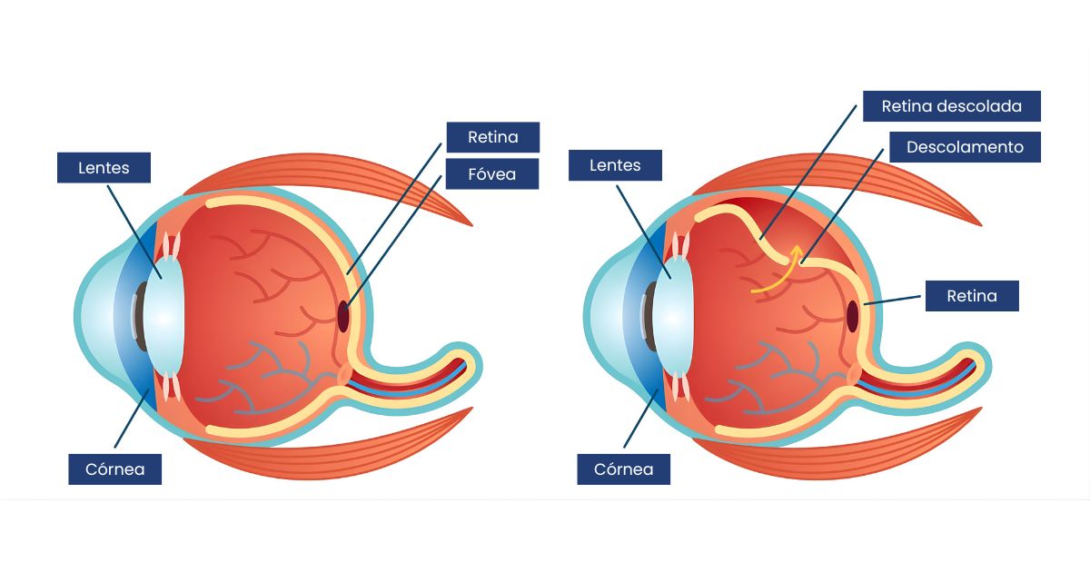 Descolamento de Retina: descubra os sinais de alerta e cirurgia para tratar